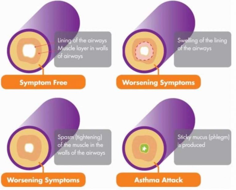 Asthma – Respiratory Physiotherapy Ireland